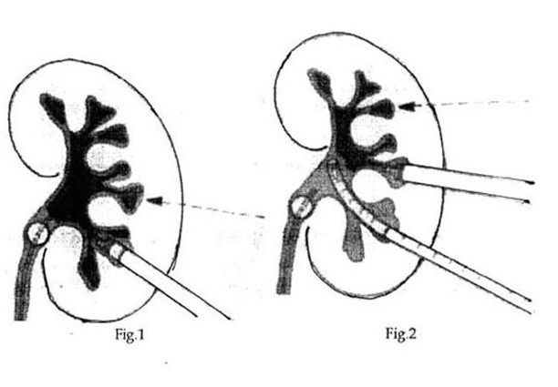 PCNL | Laparoscopic Surgeon